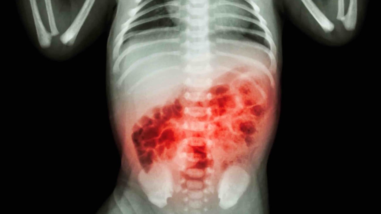 #TomorrowsDiscoveries: Necrotizing Enterocolitis in Infants - Johns ...