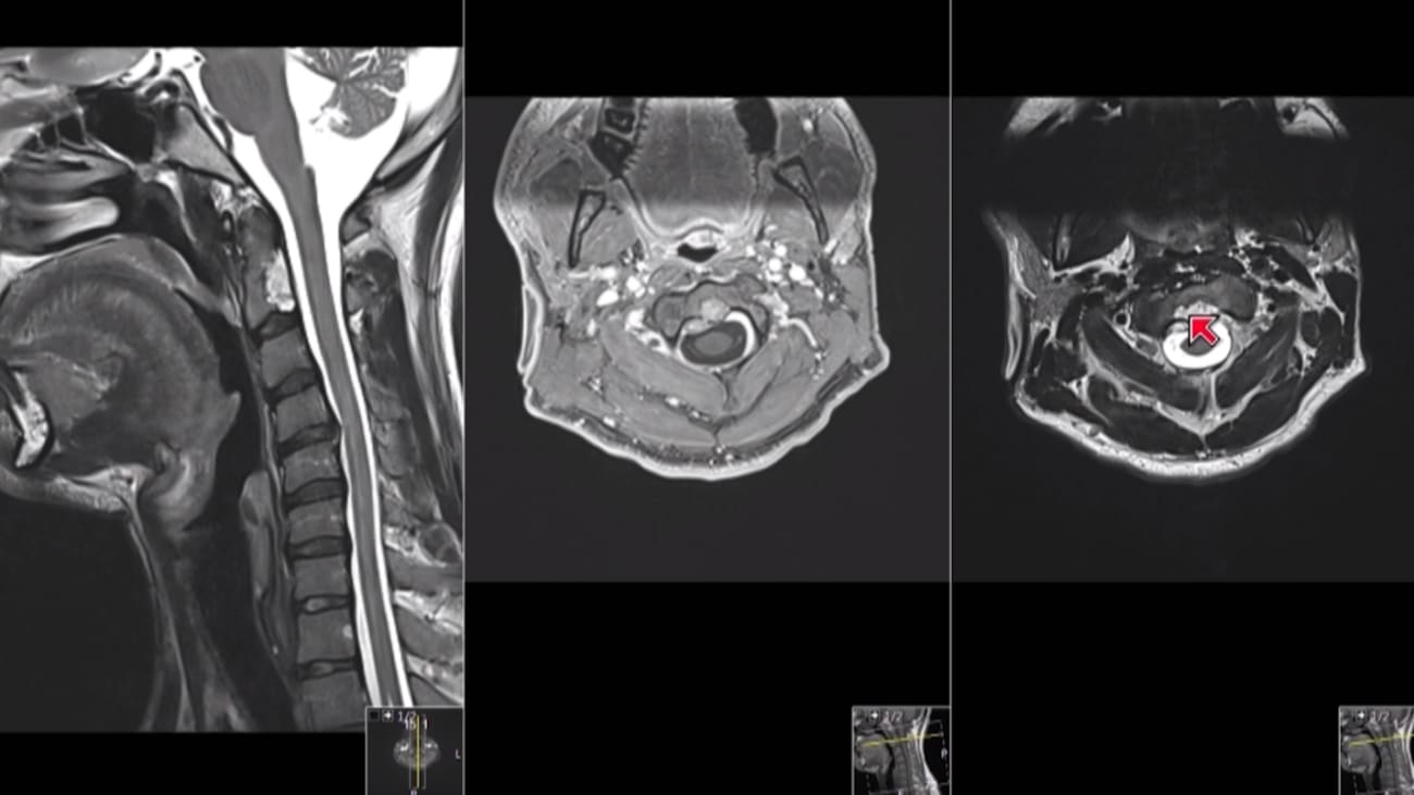 Penn Surgeons Perform World’s First En Bloc Resection of Rare Chordoma ...