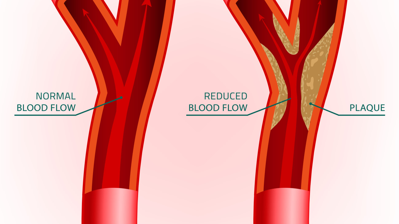 11th Annual Vascular Disease Update : FRIDAY SESSION THREE | 5 Minute ...