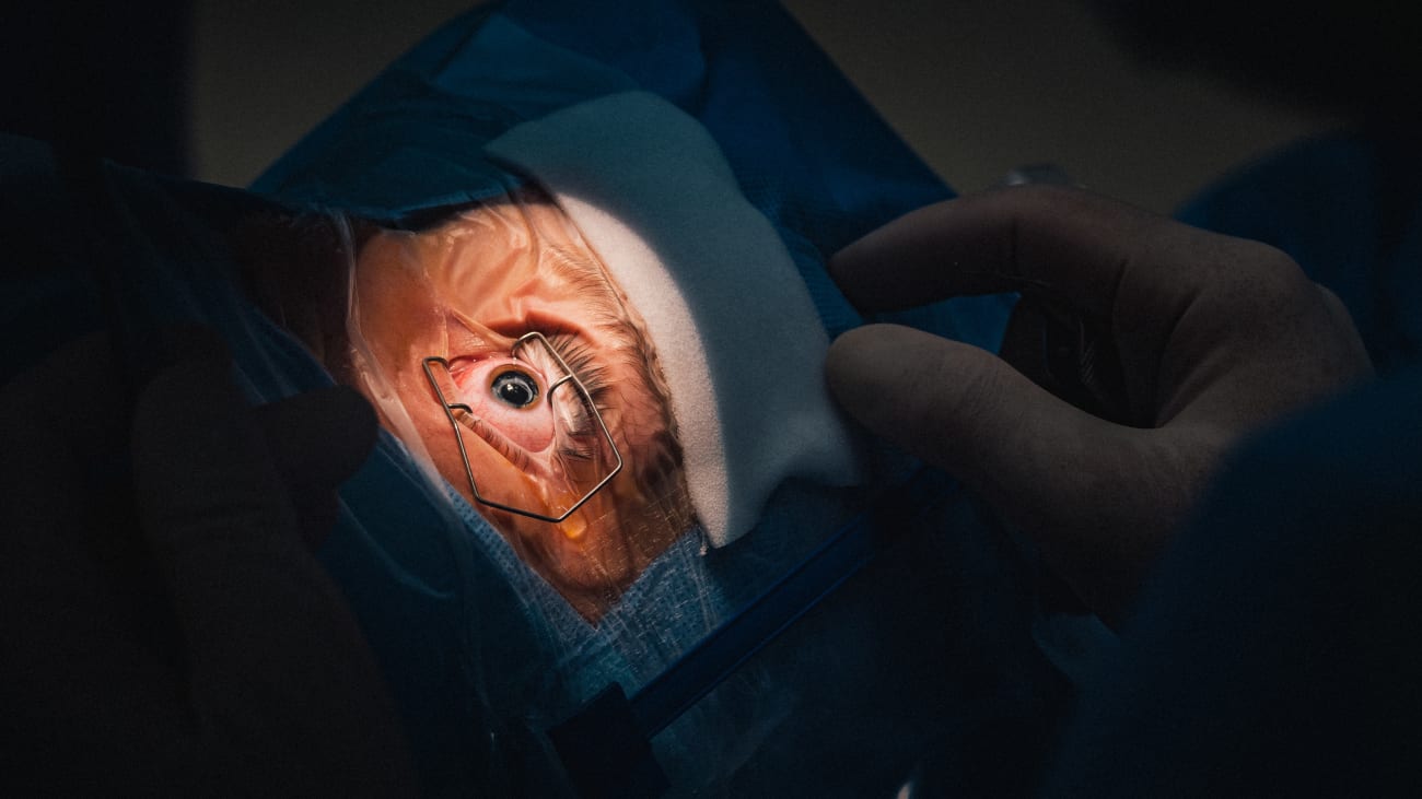 Pediatric secondary IOL placement in the sulcus space - Mayo Clinic