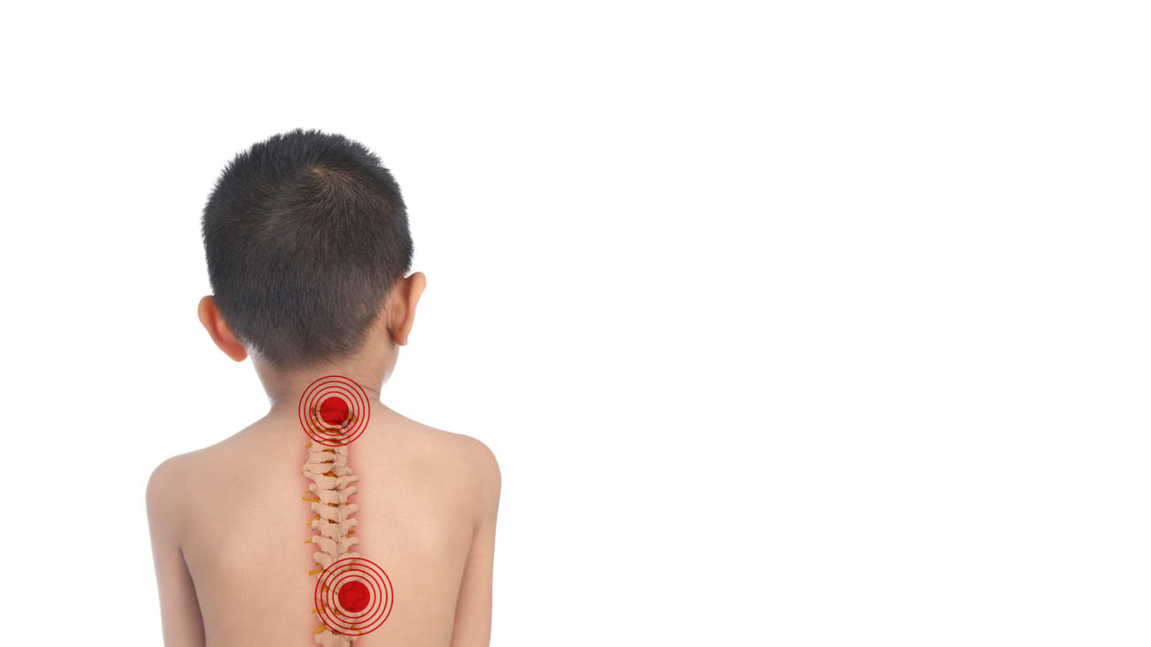 Common Spinal Deformities in Kids - UCSF Pediatrics