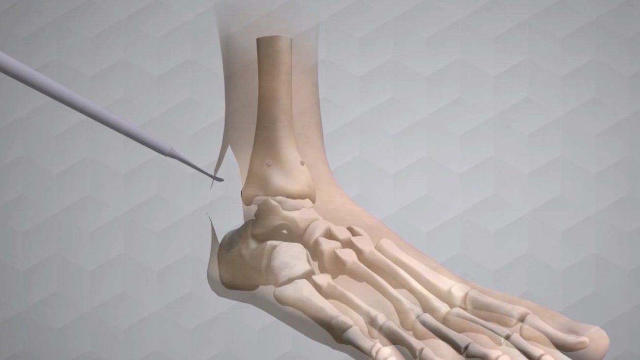 AUGMENT® Bone Graft Surgical Technique Animation [MKS161] - BroadcastMed