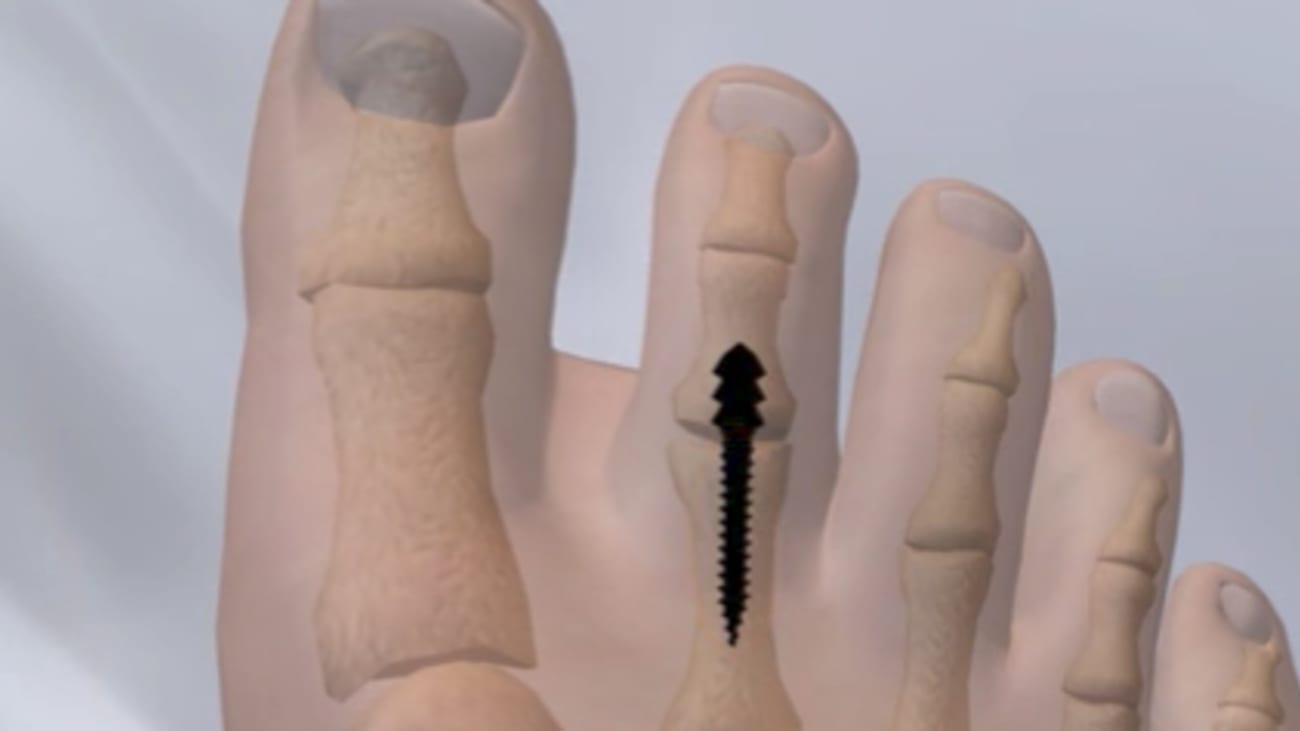 PRO-TOE™ VO Hammertoe Implant System Animation [009125] - VLC
