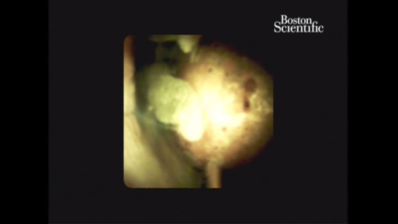 Single Session EHL for Large Bile Duct Stones, by Neil Sharma, MD ...