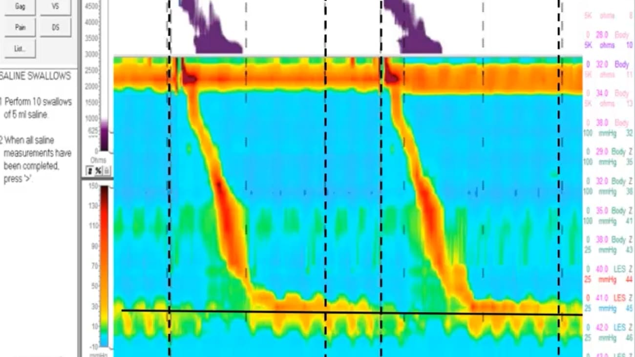 Acquisition of Esophageal Manometry Study using an HRiM Small Diameter ...