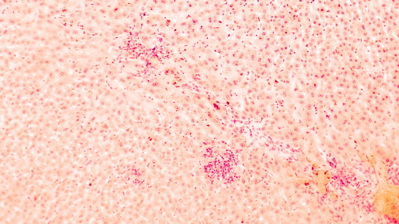 Diagnostic and Therapeutic Advances in NASH - BroadcastMed