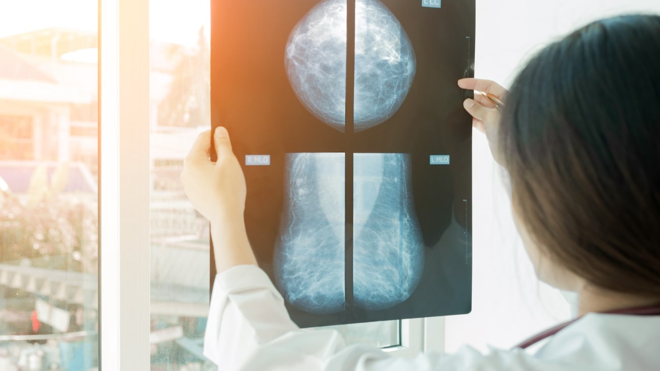 Adjuvant Palbociclib in HR+/HER2 Early Breast Cancer - Final results ...
