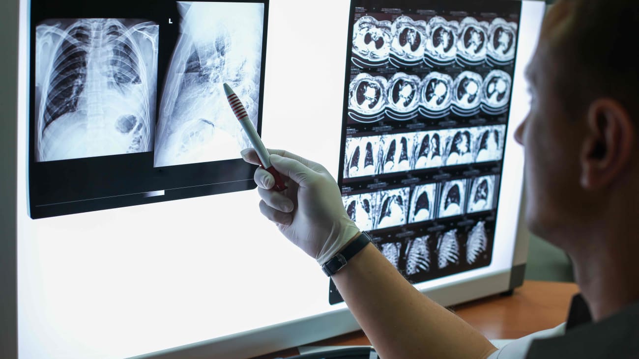 Multidisciplinary Care in a Comprehensive Thoracic Program - Sentara