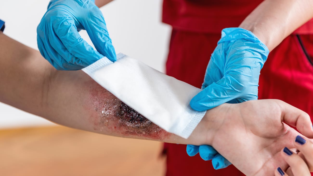 Rehabilitación del Paciente Quemado - BroadcastMed