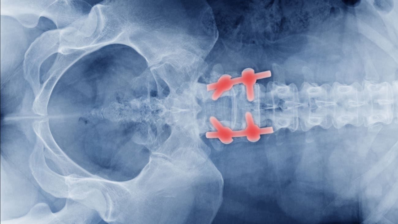 Complex Spine Surgery: Secrets of Successful Closure - UCSF MedConnection