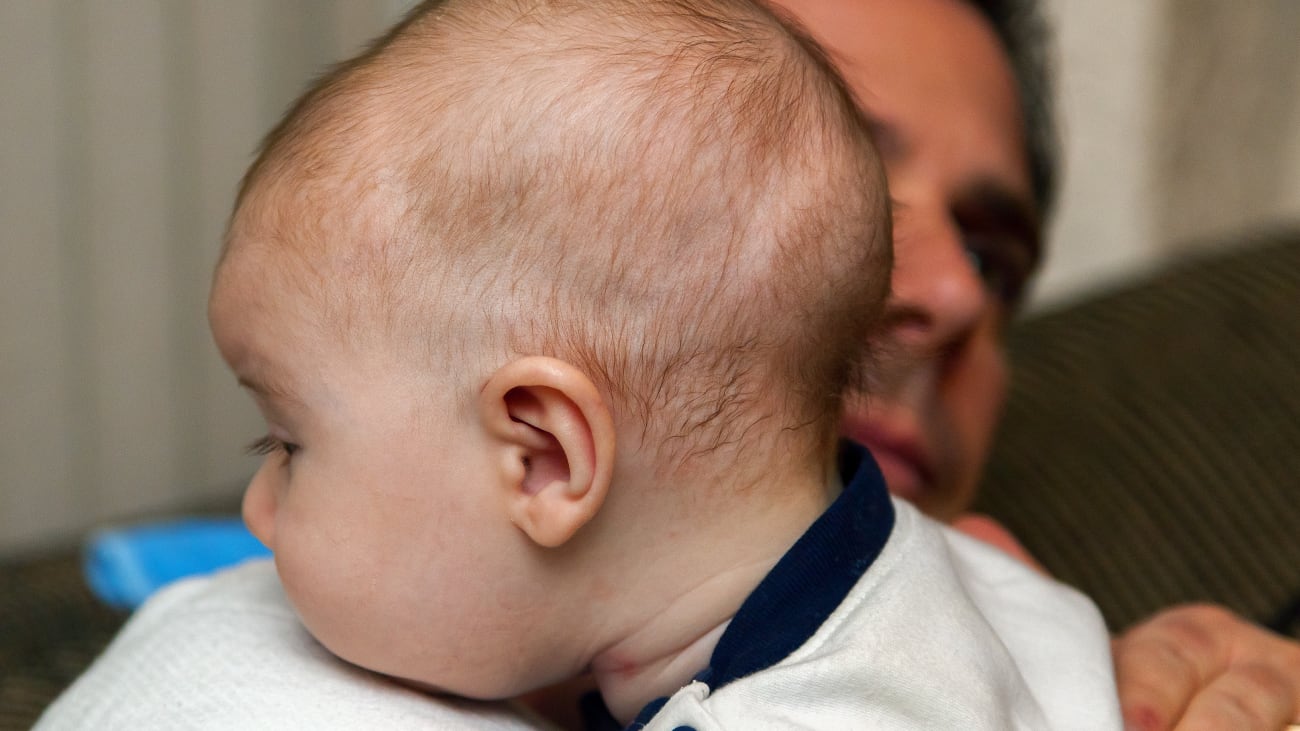 Head Shape - UCSF Pediatrics