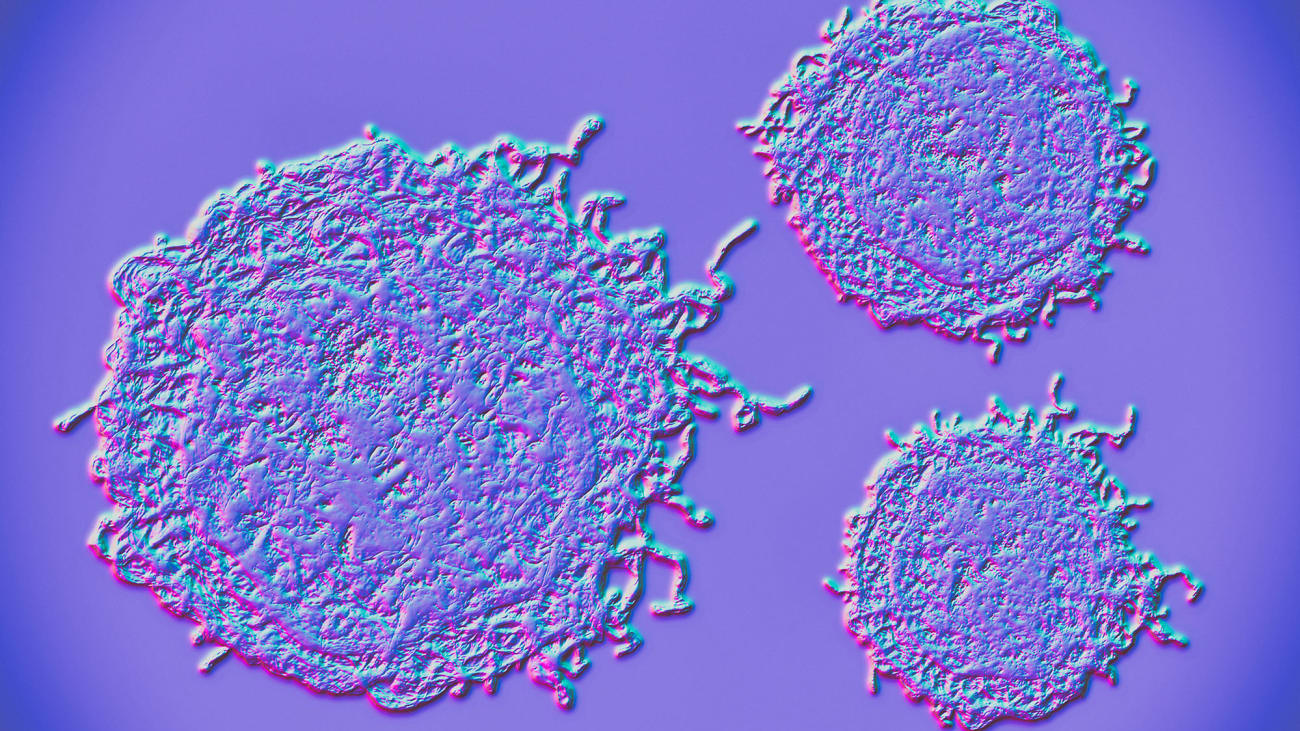 A Comprehensive Review of Cutaneous T-Cell Lymphoma - Roswell Park ...