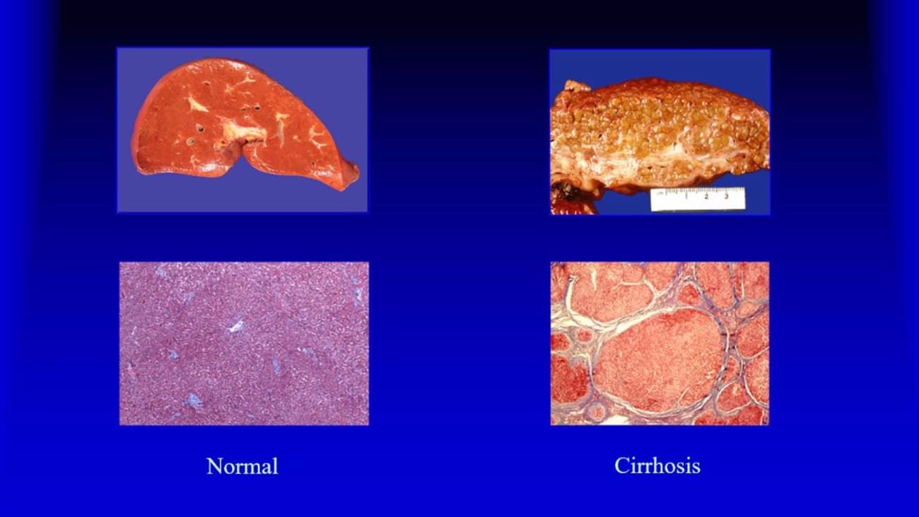 Cirrhosis - Physician's Channel - Mount Sinai New York
