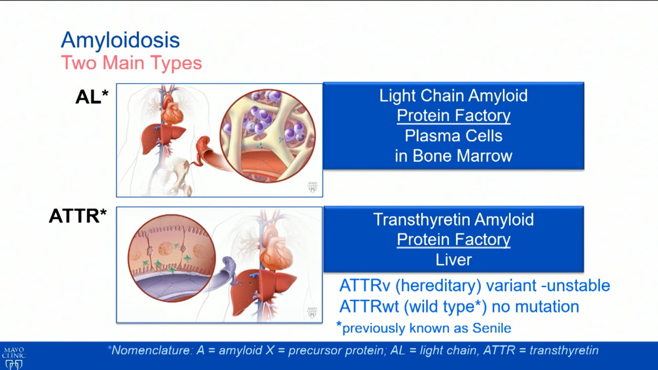 Transthyretin amyloid and new treatment options - Mayo Clinic