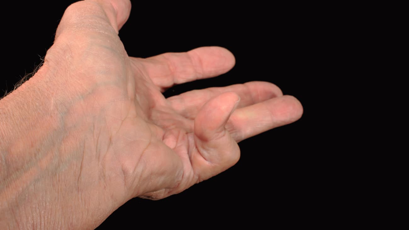 Making Bent Fingers Go Straight - BroadcastMed