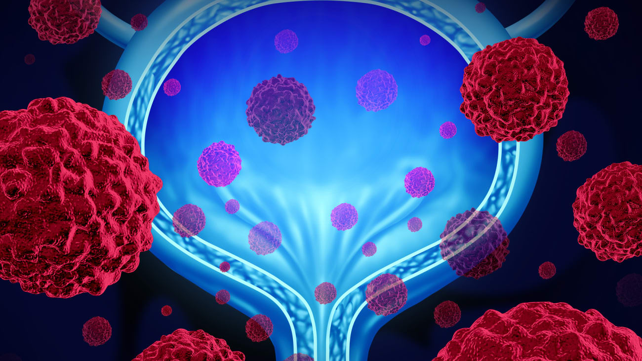 Advances in Treating Women’s Bladder Cancer - BroadcastMed