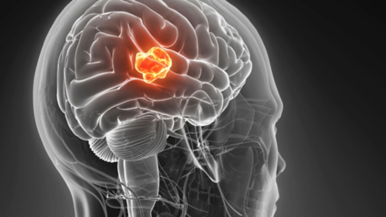 Light Therapy For Brain Tumor at Jennifer Dermody blog