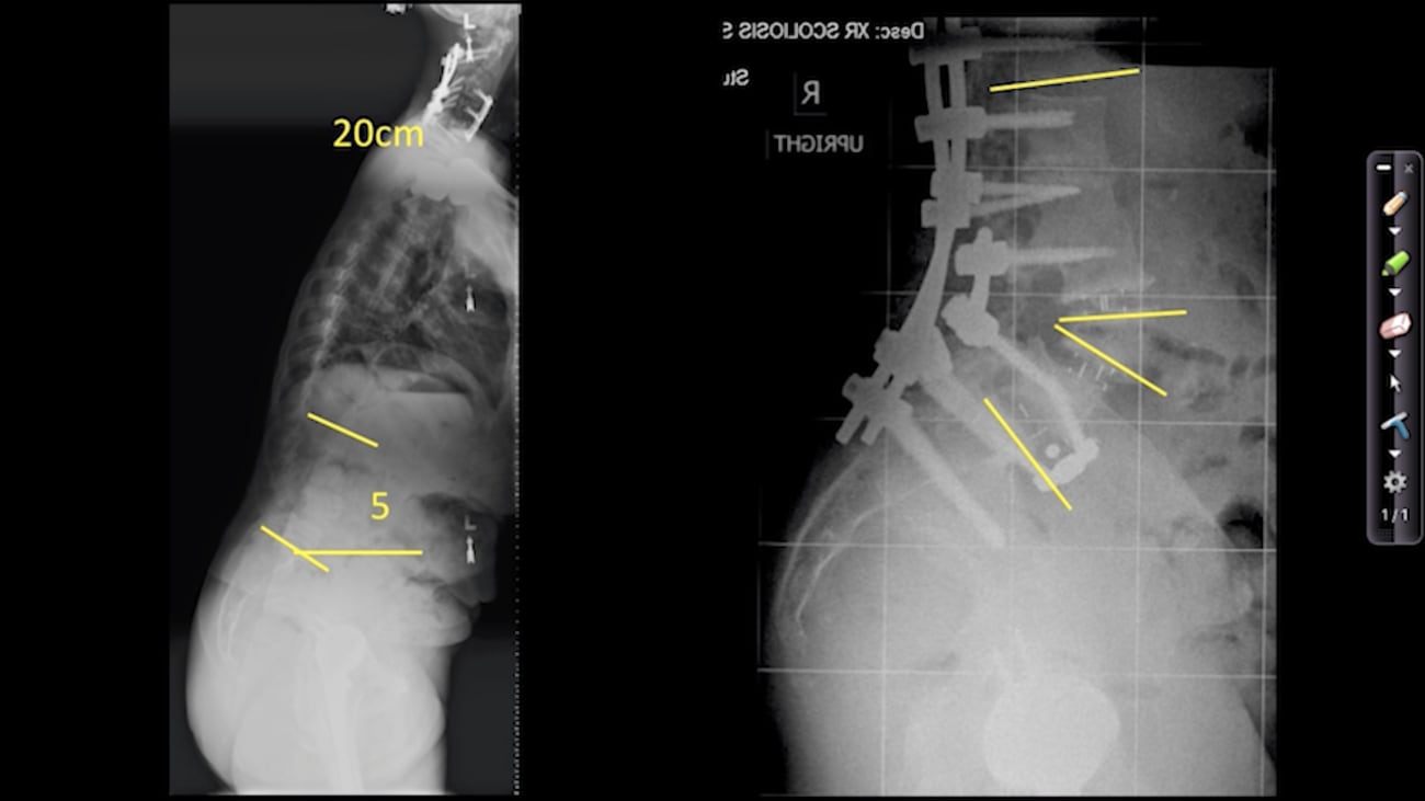 Approach to the Older Patient with Spinal Disorders: Surgery - UCSF ...
