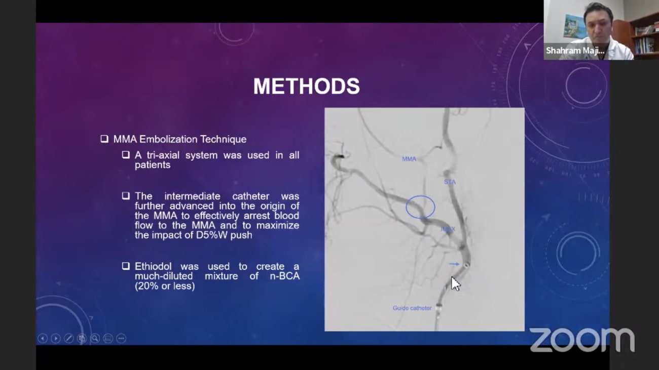 MMA Embolization for Subdural Hematoma: The Mount Sinai Experience ...