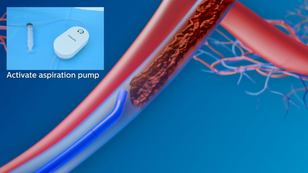 Lightning Flash Mechanical Thrombectomy System at Heidi Tan blog