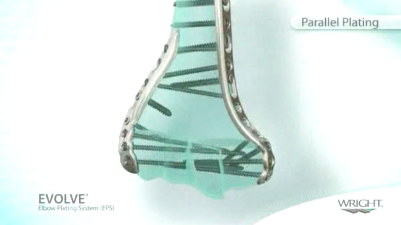 EVOLVE™ Elbow Plating System (EPS) Design Theory 1 - Design Goals ...