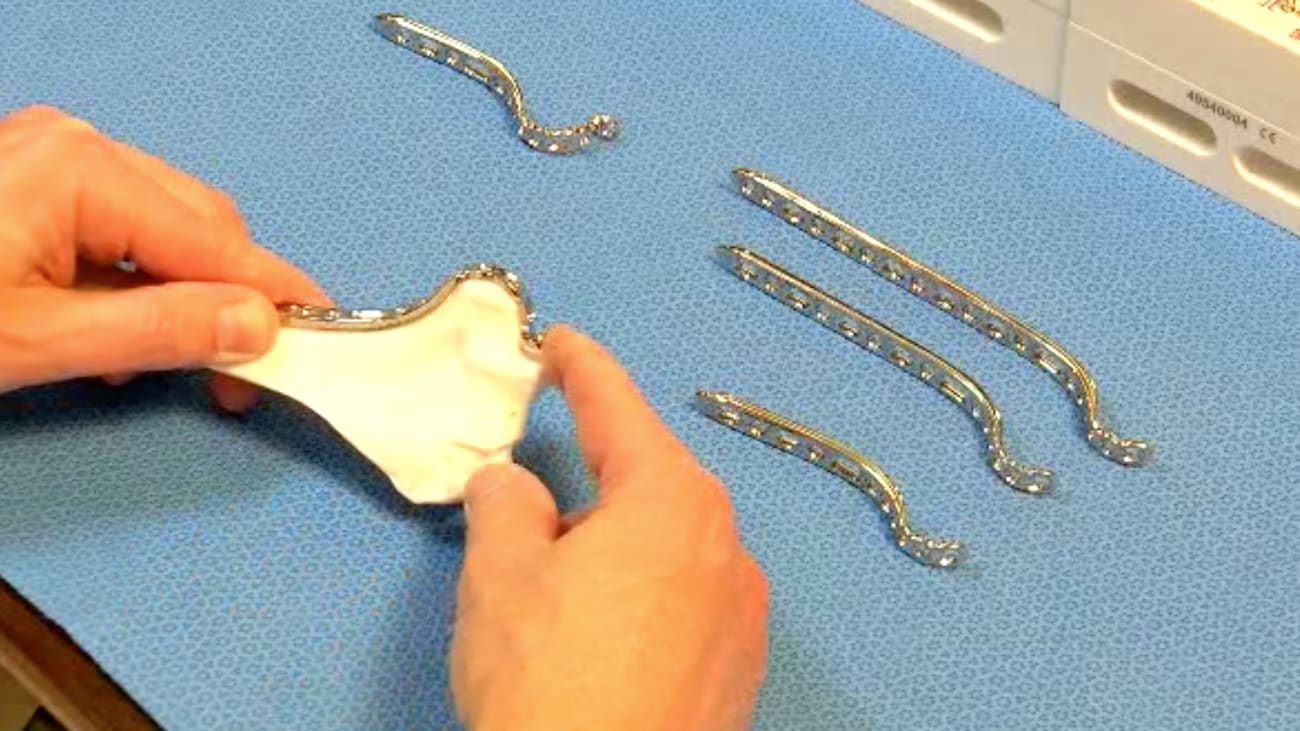 EVOLVE™ Elbow Plating System (EPS) Design Theory 2 - Distal Humerus ...