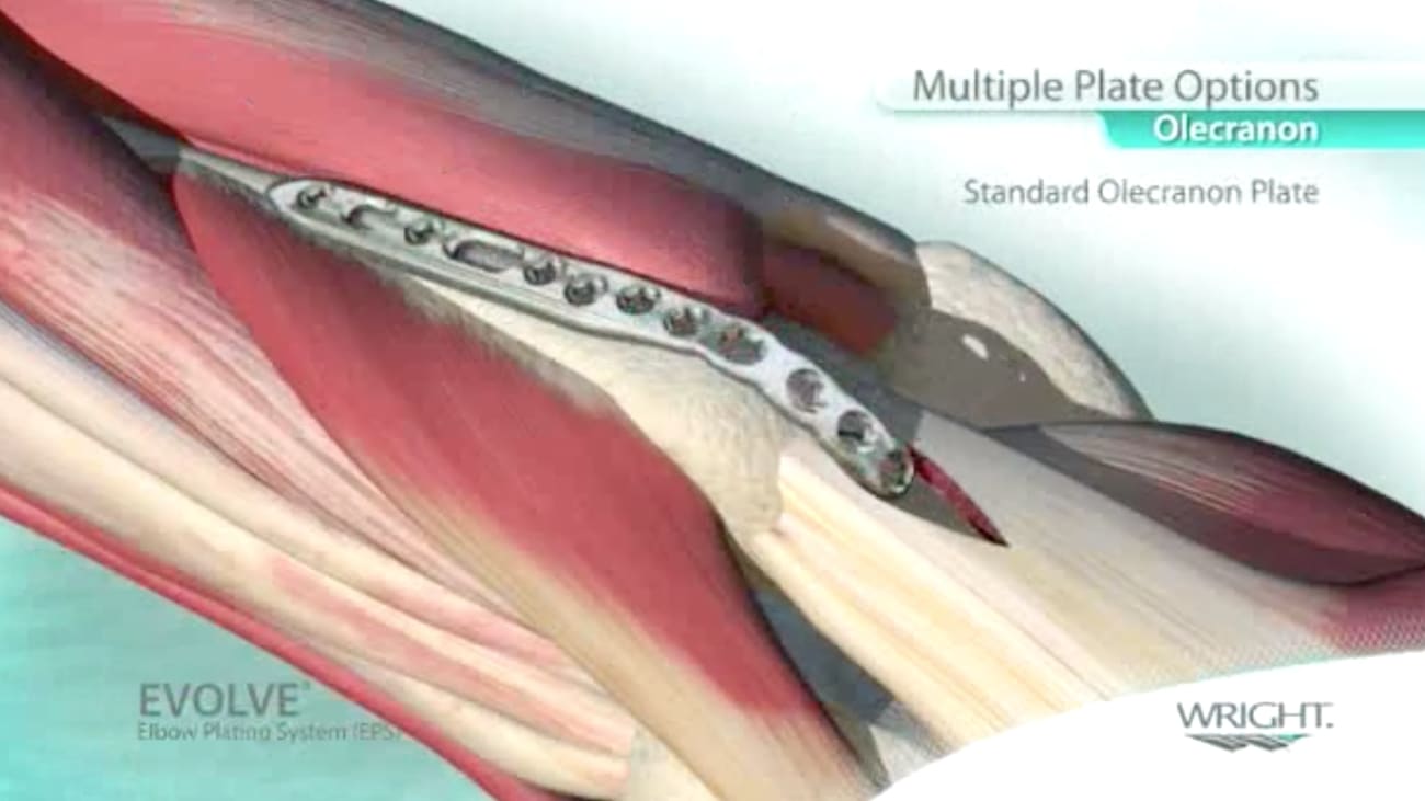 EVOLVE™ Elbow Plating System (EPS) Design Theory 3 - Proximal Ulna ...