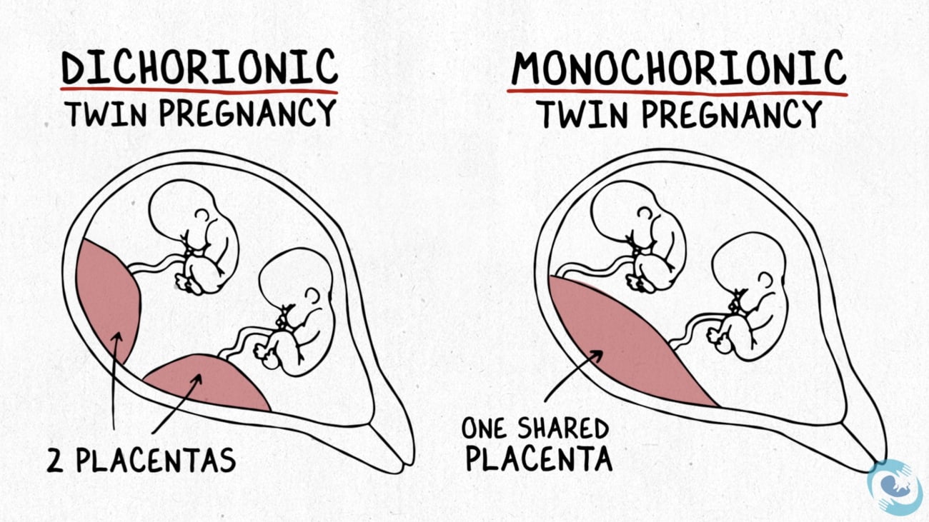 The Difference Between Dichorionic and Monochorionic Twins - UCSF ...