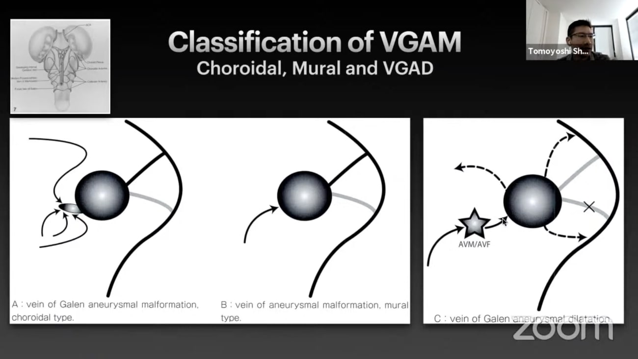 Entrance to the Vein of Galen Aneurysmal Malformation - Physician's ...