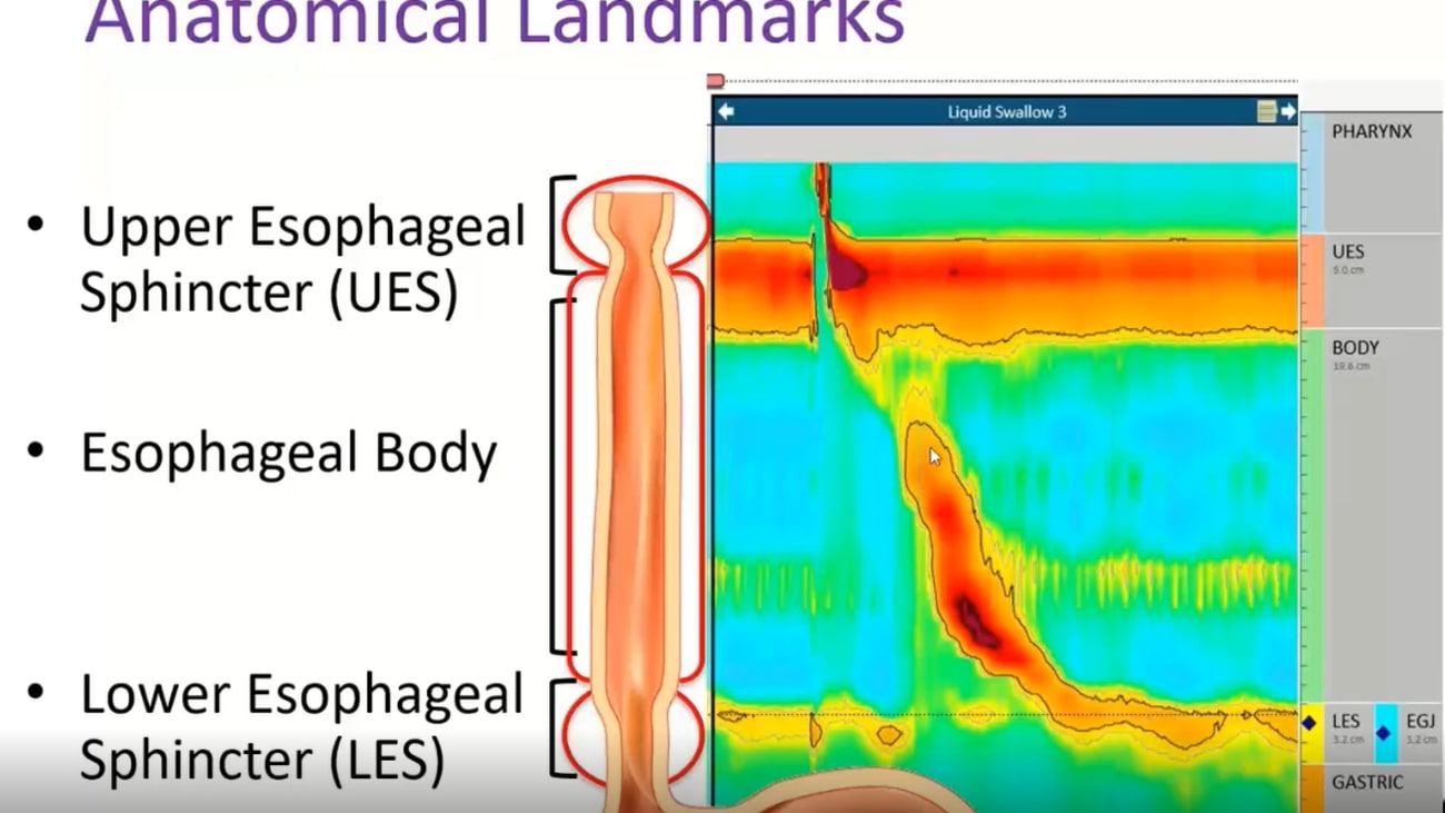 High Resolution Esophageal Manometry – Start to Finish Webinar Series ...