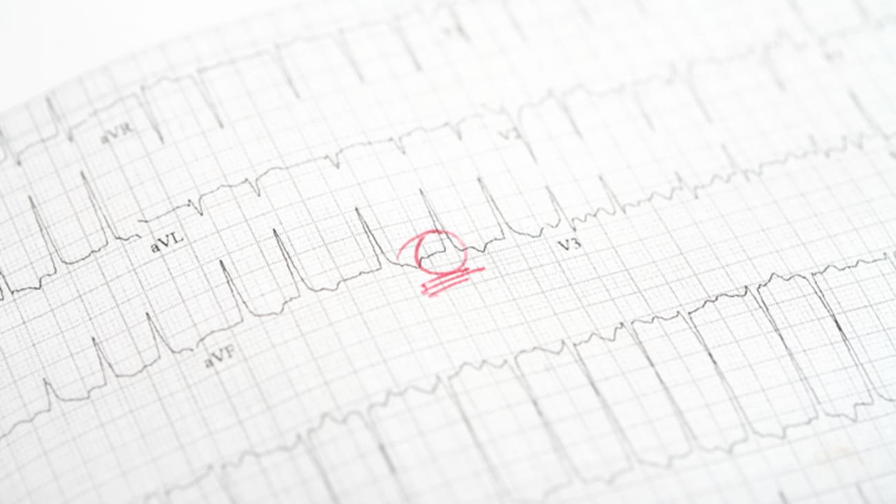 Pulsed Field Ablation- First-Line Treatment for Atrial Fibrillation ...