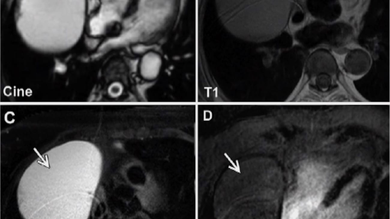 Cardiac Masses and Sources of Emboli: Role of Echo/CMR/CT - Part 2 of 2 ...