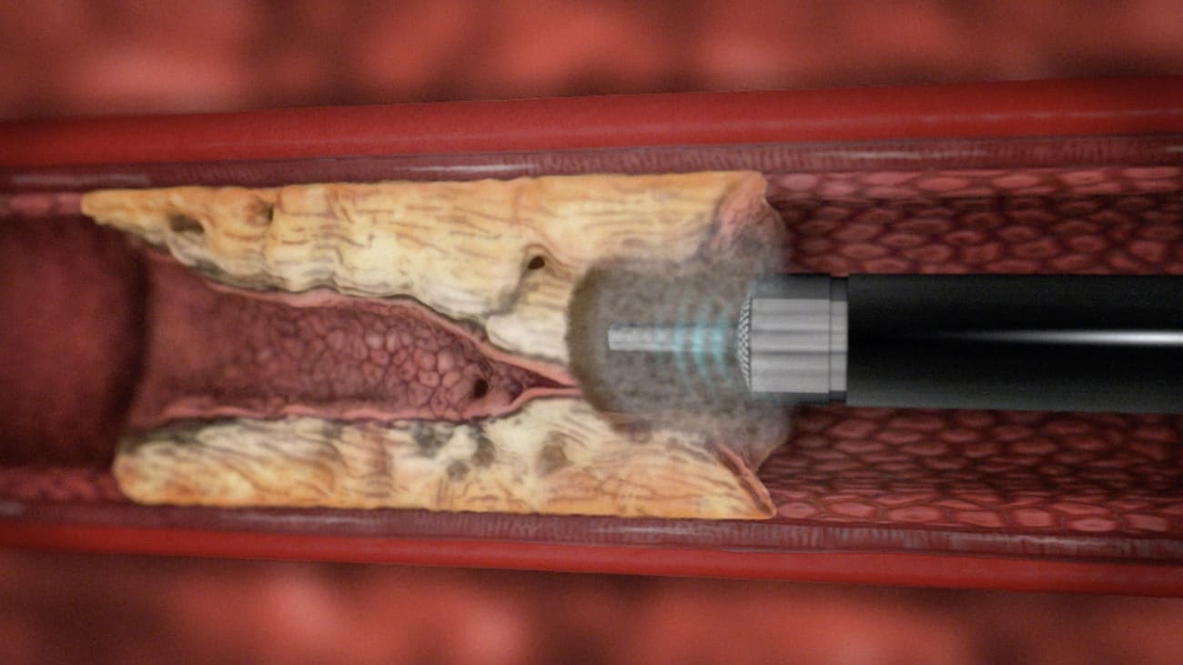 Philips Turbo-Elite Laser Catheter - Philips Image Guided Therapy ...