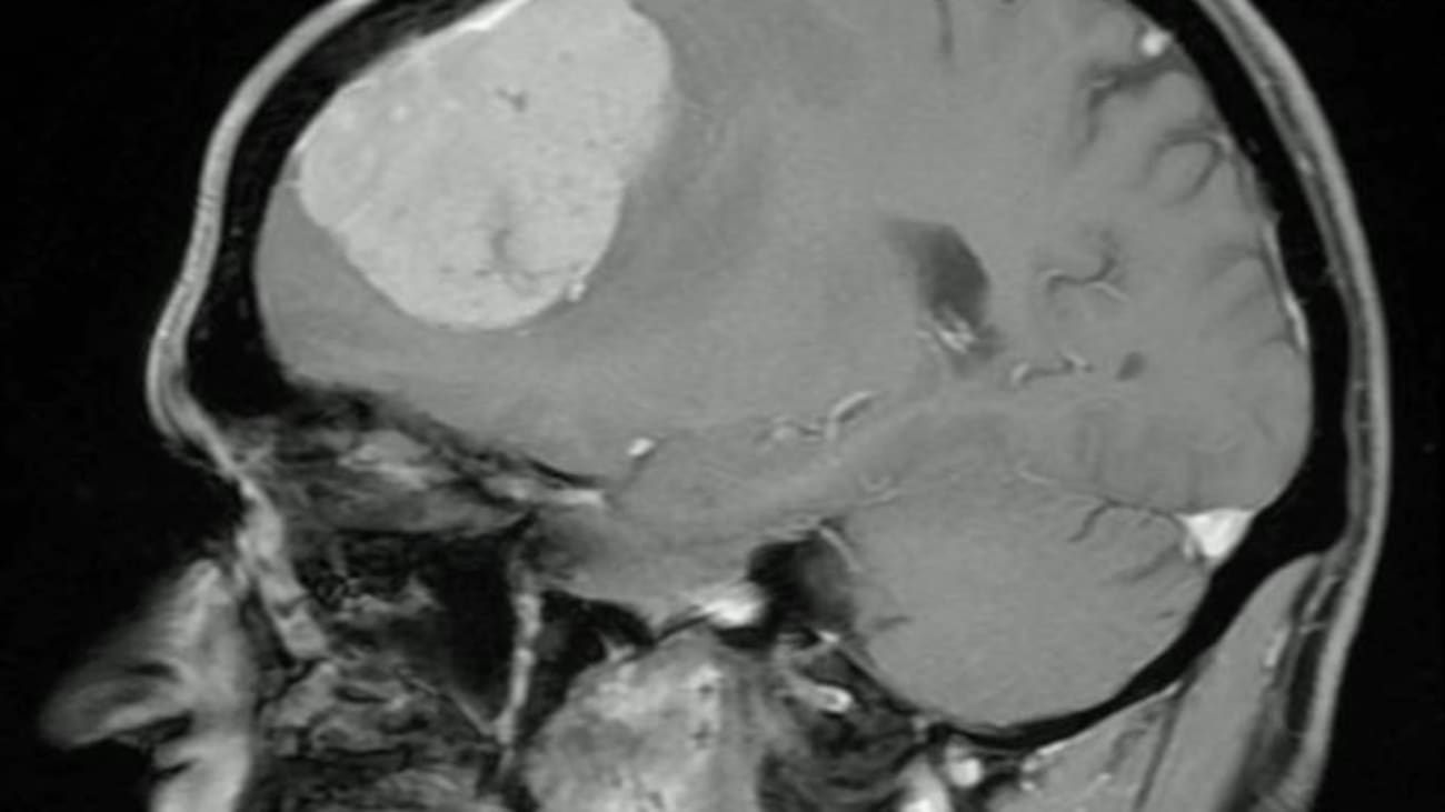 Penn Medicine’s John Y.K. Lee, MD, MSCE, discusses TumorGlow ...