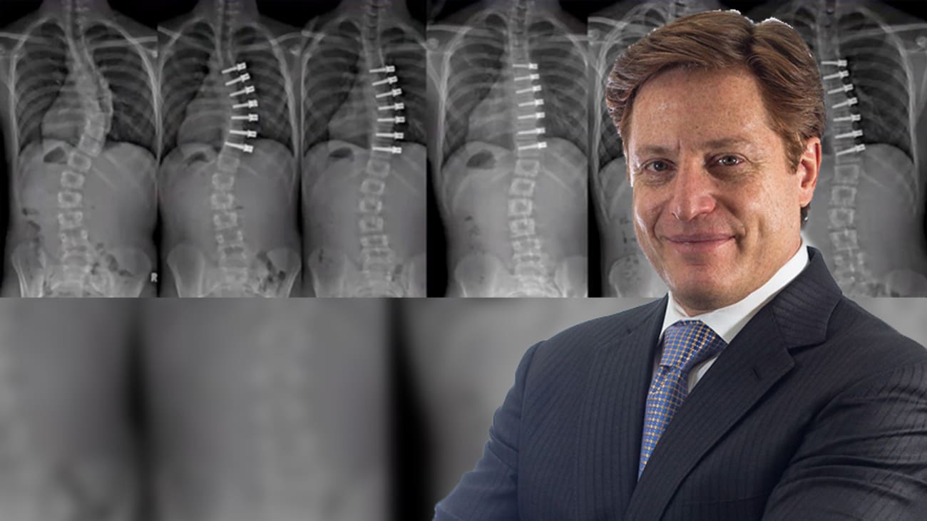 Vertebral Body Tethering: Rationale, Results and Revisions, State of ...