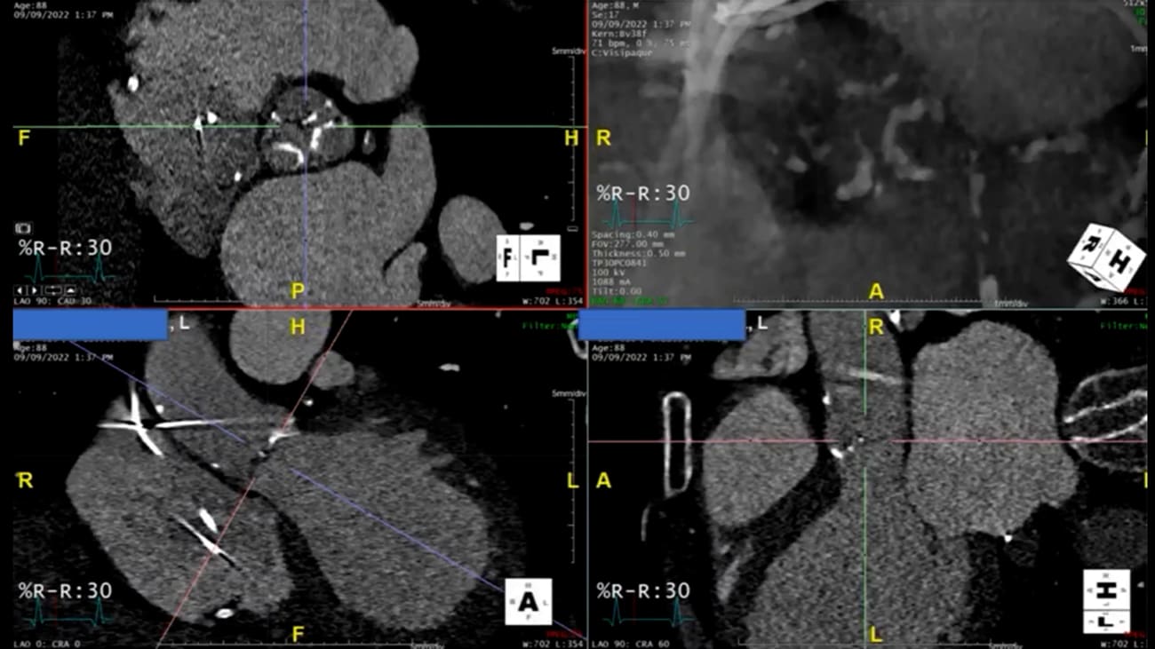 Low-Flow, Low-Gradient Aortic Stenosis - Sentara
