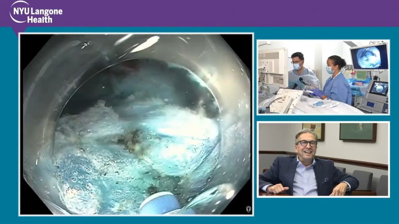 Long Island Live Case: Colon ESD Recurrent ICV/Cecal Adenoma - Lumendi