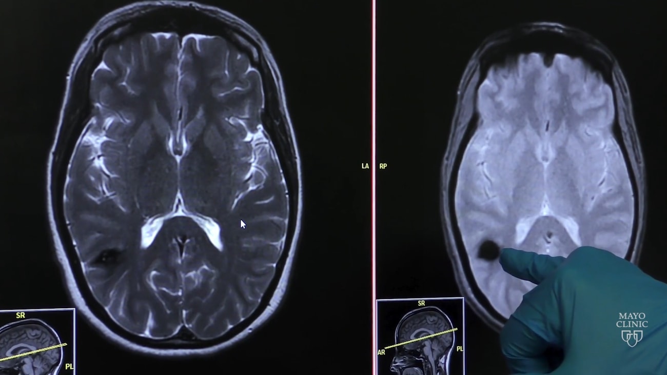 Cavernous malformations — Neurovascular disease explained - Mayo Clinic