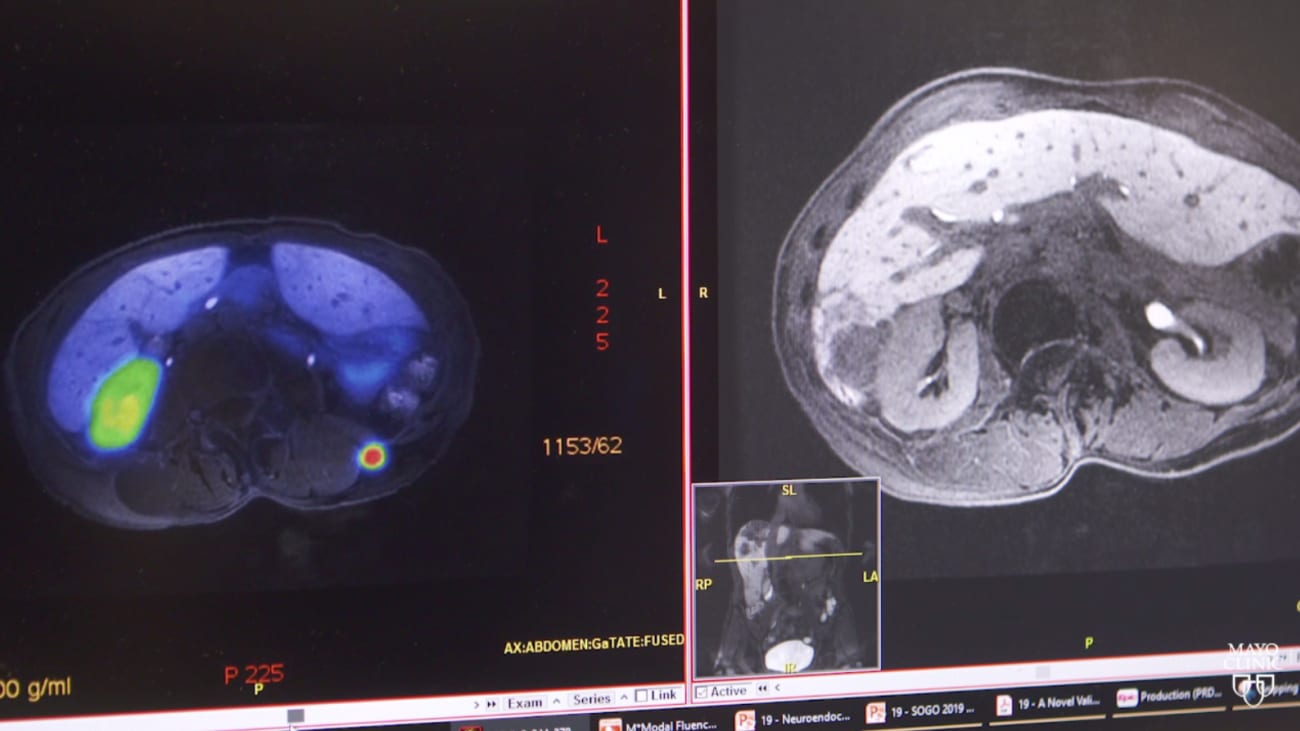 Symptoms and treatment of pancreatic neuroendocrine tumors - Mayo Clinic