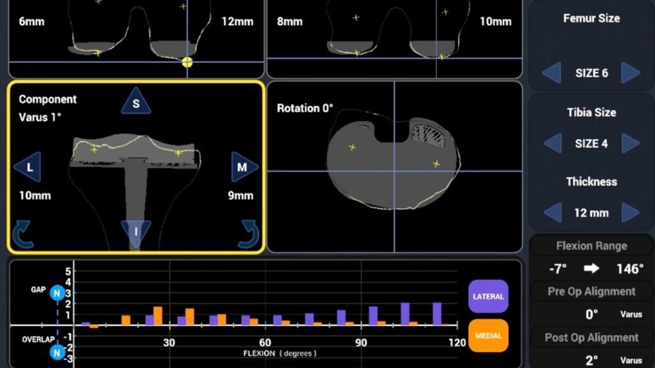 NAVIO 7 TKA Gap Balancing Workflow - Smith & Nephew