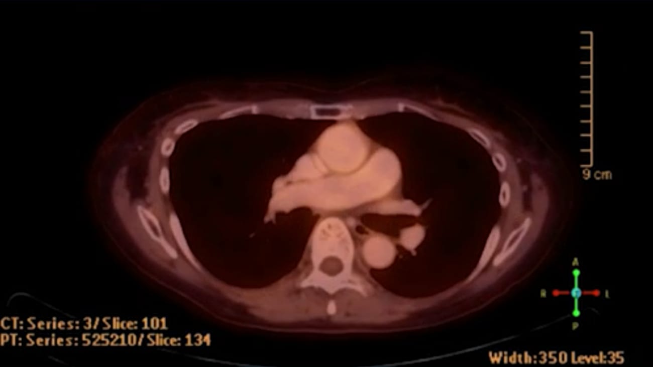 Personalized Therapy for Early-Stage Lung Cancer at UCSF - UCSF ...