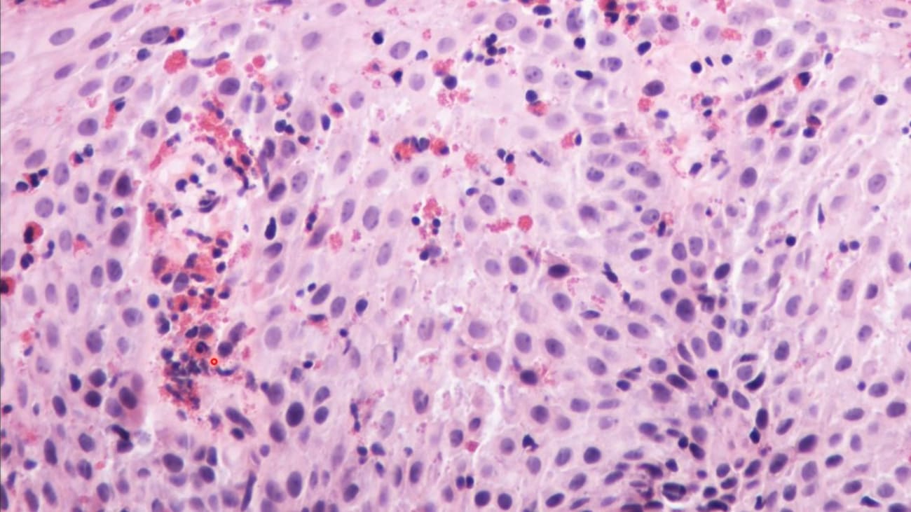 Upper GI Pathology - Physician's Channel - Mount Sinai New York