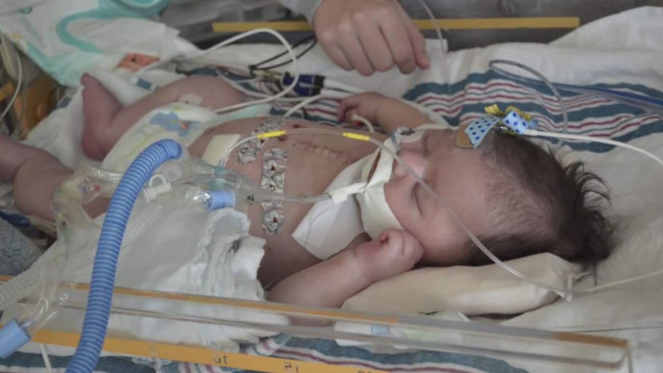 ECMO and a Ross Konno operation saved 6-week old Ruby Munoz - BroadcastMed