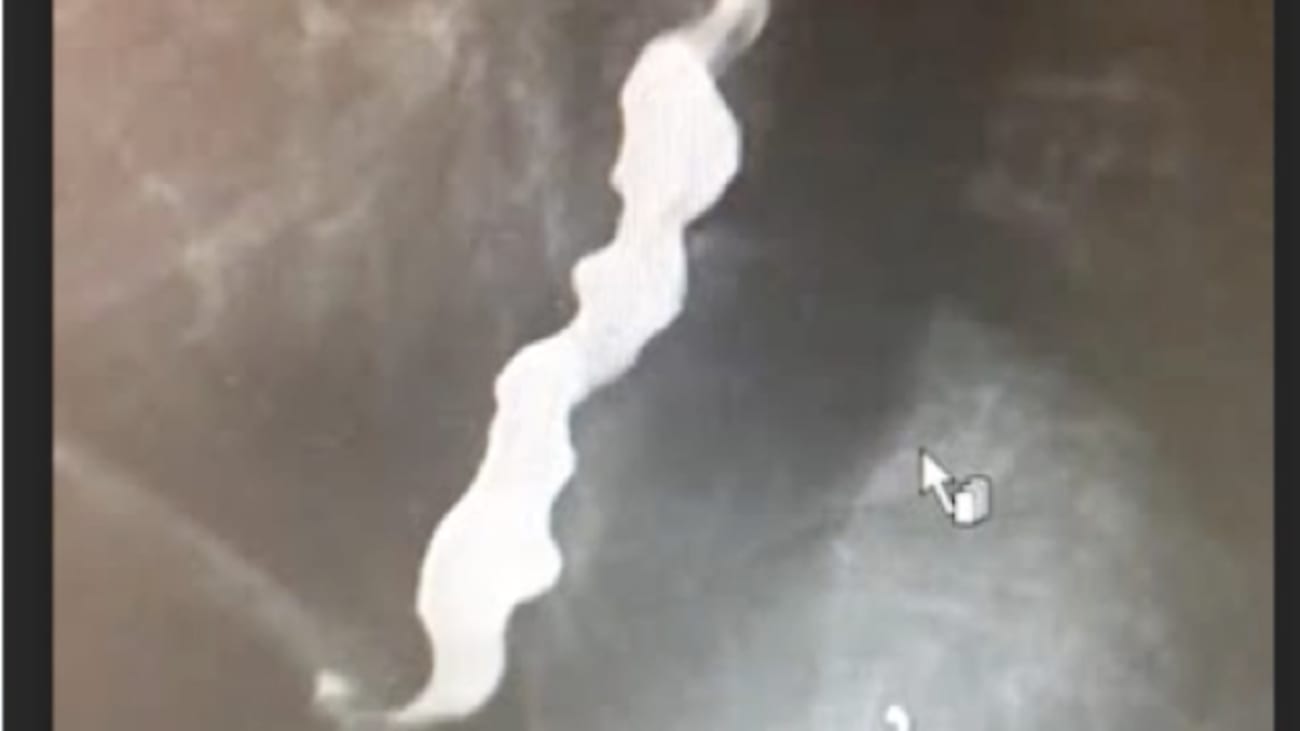 Motility disorders of esophagus - Physician's Channel - Mount Sinai New ...