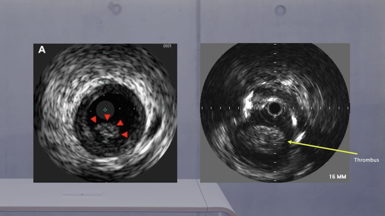 IVUS thrombus PAD - Philips Image Guided Therapy Devices Academy