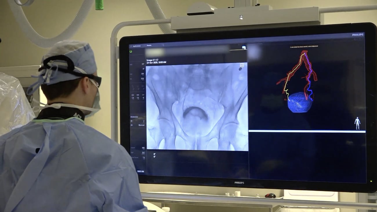 Interventional Radiology: Prostate Artery Embolization - Sentara