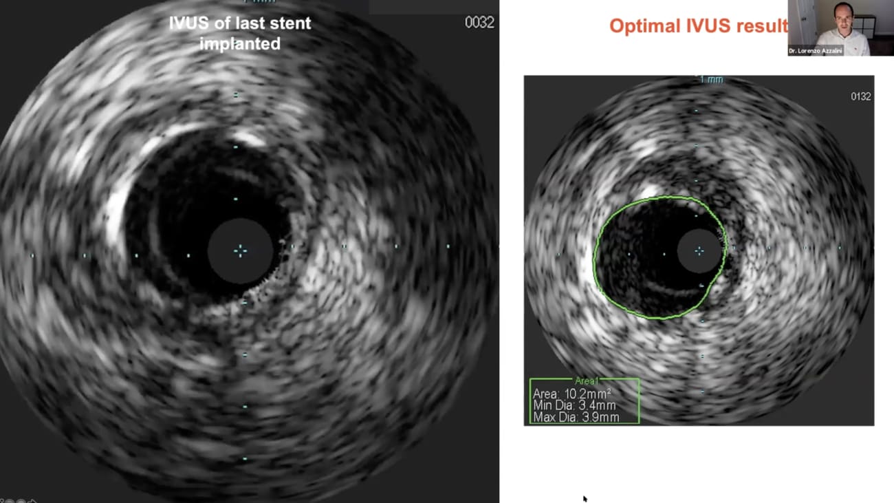 Optimizing coronary stenting: the role of IVUS in today’s precision PCI ...