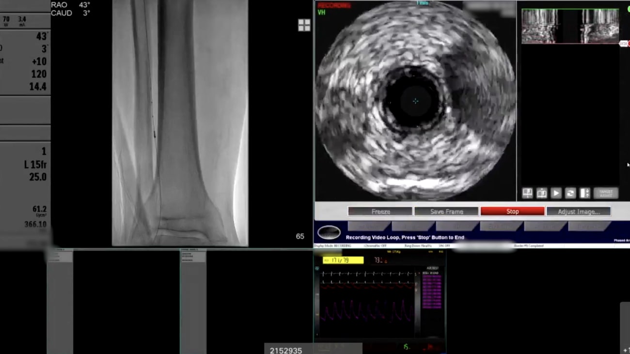 PAD Live: Strategies for success with IVUS, laser, atherectomy, and ...