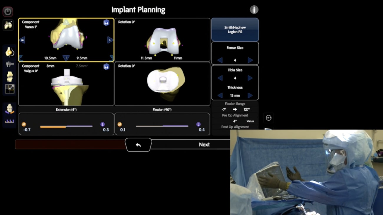 Performing Revision Knee Arthroplasty Using the CORI™Surgical System ...
