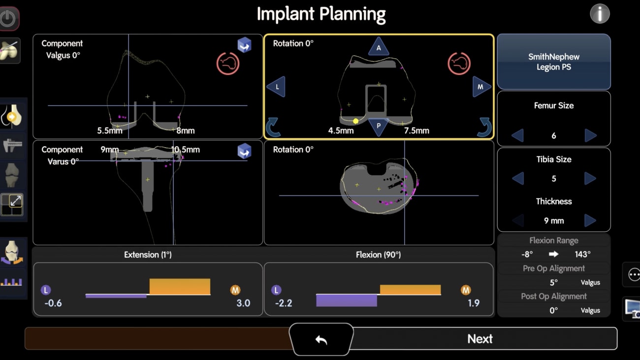 Surgical Demonstration: Revision Knee Arthroplasty with CORI Surgical ...